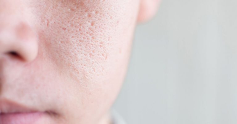 Grove poriën - SkinEffects